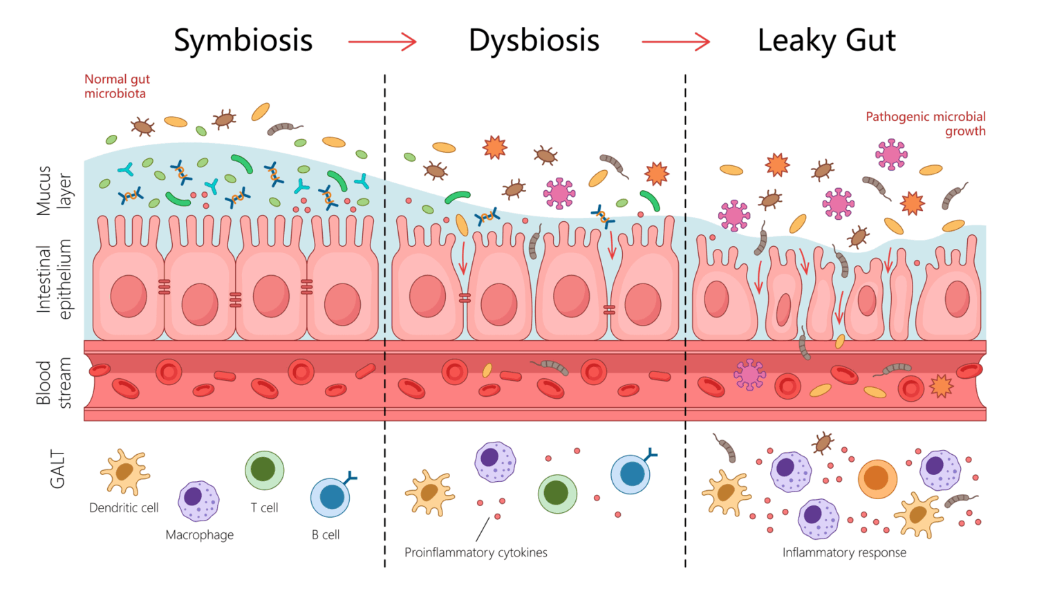 Comment reconnaître une dysbiose intestinale ? - Anne-Christine DUSS